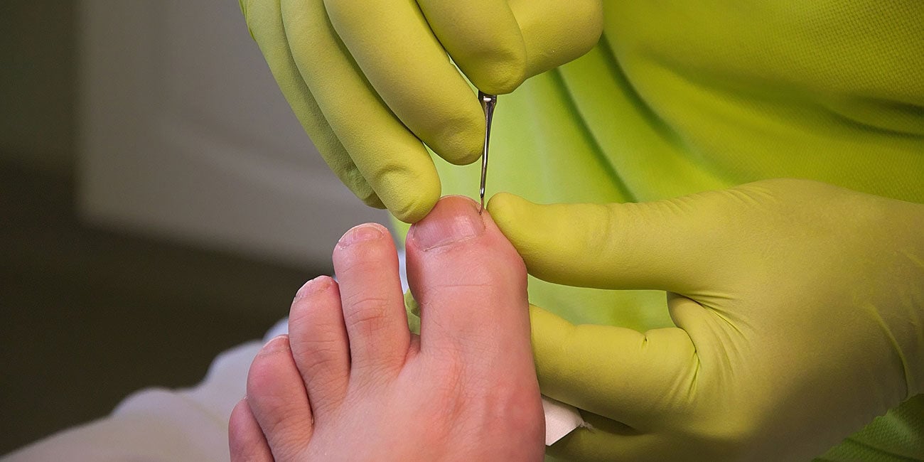 Orthonyxie erklärt: Eingewachsene Nägel per Nagelspange korrigieren