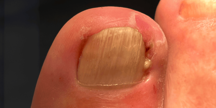 Eingewachsene Zehennägel (Unguis incarnatus / Onychocryptosis)