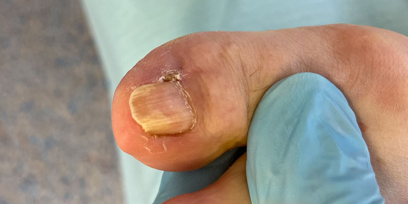Nagelbettentzündung am Zeh: Tipps & Therapie